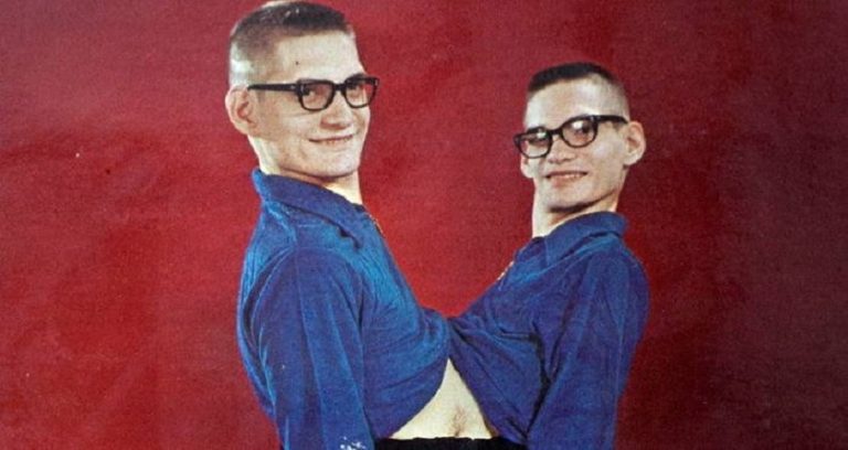 Ronnie And Donnie Galyon: Najdlhšie žijúce siamské dvojičky v histórií ...