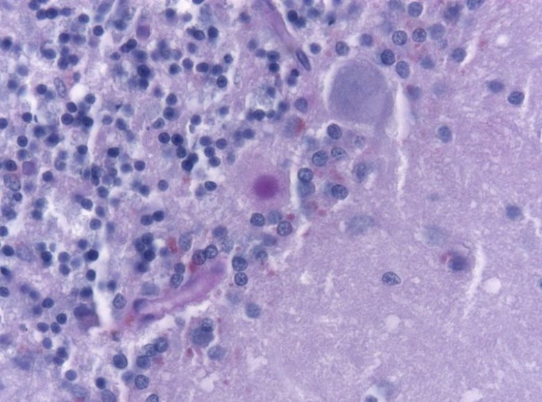 Kuru choroba: Rozvinula sa v kmeni Fore pojedaním mozgov | interez.sk