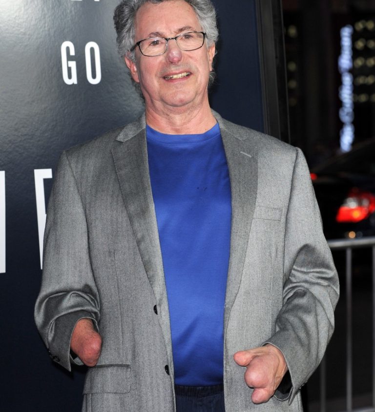 Odpadol mu nos, amputovali mu ruku a prsty: Beck Weathers prežil noc na ...