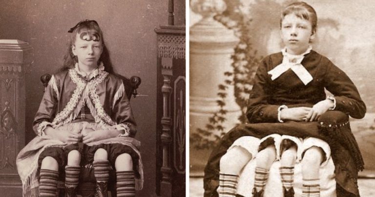 Myrtle Corbin mala neobyčajný život. Štvornohá dievčina z Texasu čelila ...